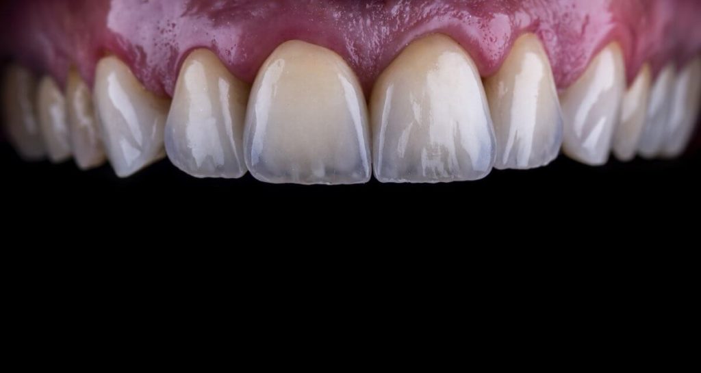 Non-Prep-Veneers - Veneers